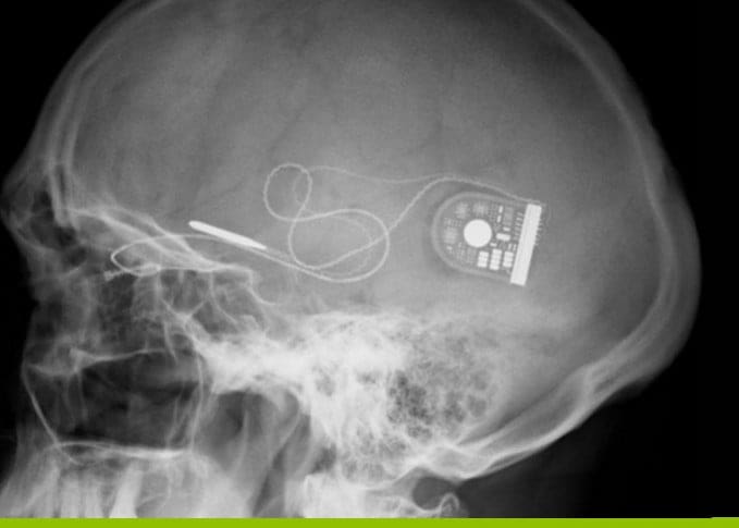 Premiers résultats des implants cérébraux de la DARPA : ils améliorent ...